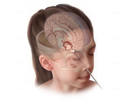 Brain cancer treatment with neuro endoscopy surgery