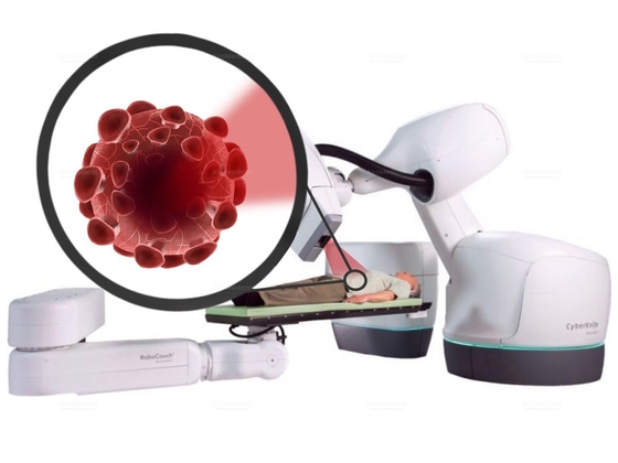 Cancer treatment with CyberKnife