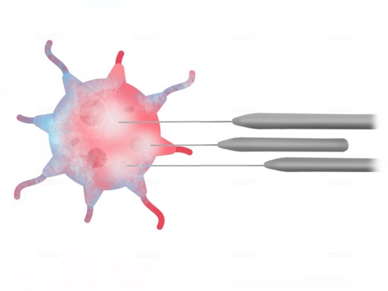 Cancer treatment with cryosurgery