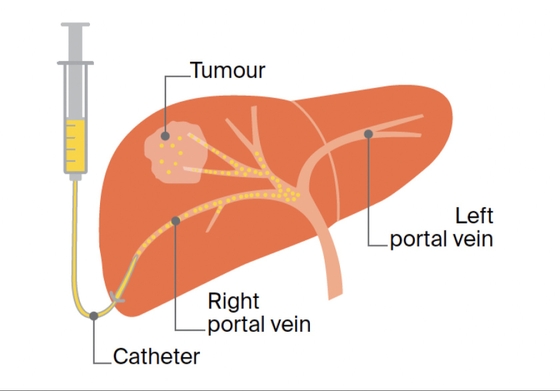 Liver cancer treatment with transarterial chemoembolization (TACE) | 2 ...