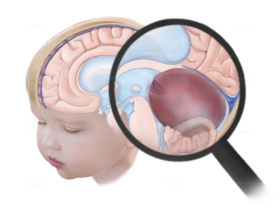 Brain cyst diagnosis
