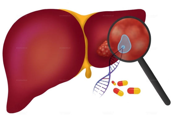 Liver cancer treatment with targeted therapy