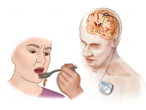 Essential tremor treatment with deep brain stimulation (DBS)