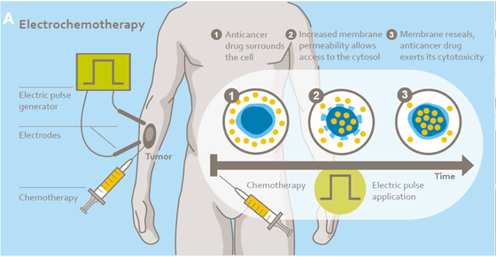 Electrochemotherapy (Reversible Electroporation) for Cancer Treatment ...