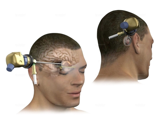 Brain tumor treatment with neuro endoscopy surgery