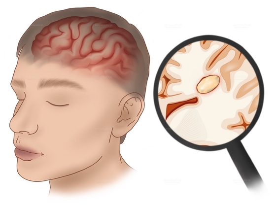 Brain abscess diagnosis