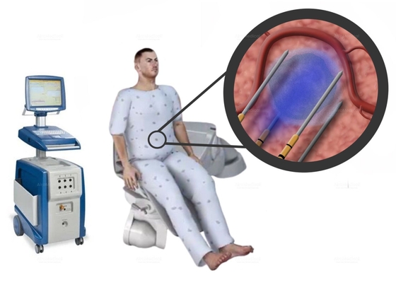 Cancer treatment with NanoKnife