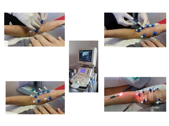 Photodynamic Therapy (PDT) at Centre of Advanced Medicine, Frankfurt ...