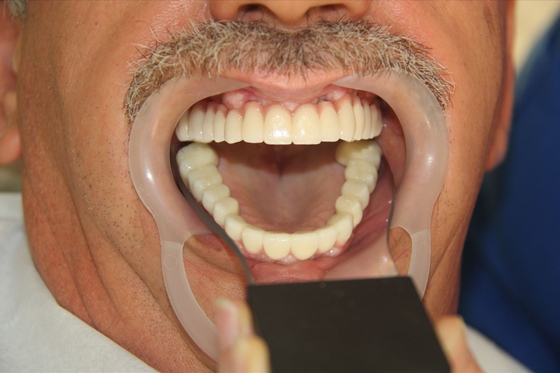 All-on-6 Dental Implants (one arch) | Evoss Implant + Zirconium Crown