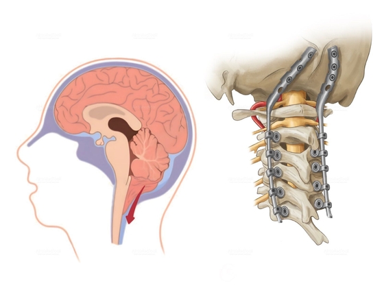 Chiari malformation treatment with decompression surgery