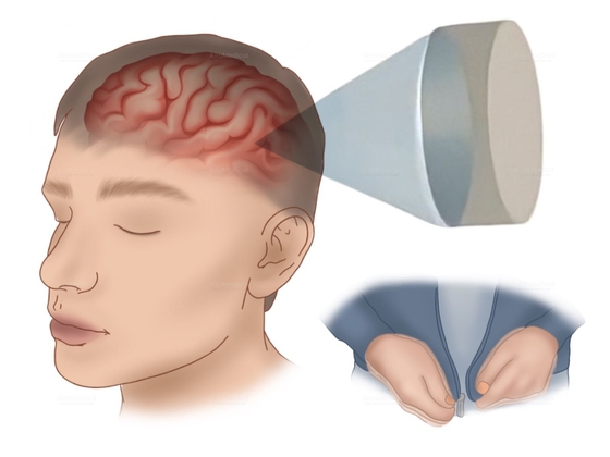 Essential tremor treatment with focused ultrasound surgery