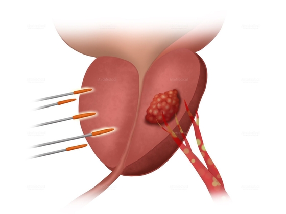 Prostate cancer treatment with vascular-targeted therapy TOOKAD