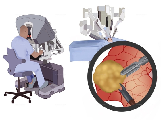 Thyroid cancer treatment with robotic-assisted thyroid surgery
