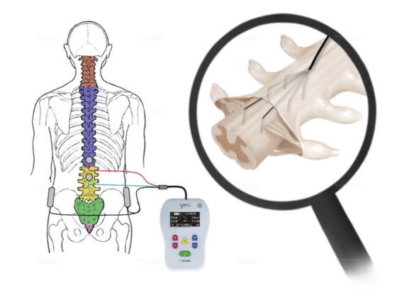 Spinal injury treatment with electrical spinal cord stimulator