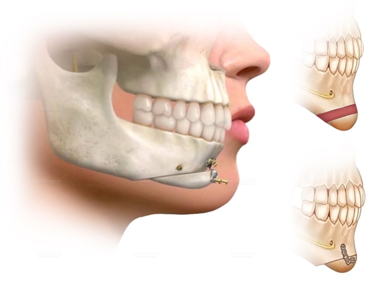 Chin reduction surgery