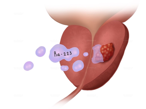 Prostate cancer treatment with Radium 223 PSMA therapy