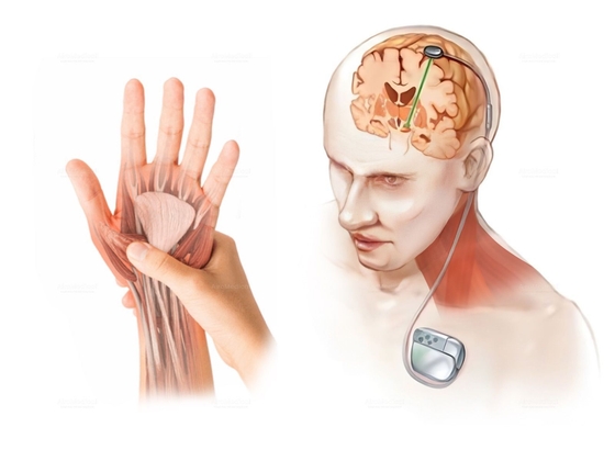 Dystonia treatment with deep brain stimulation (DBS)