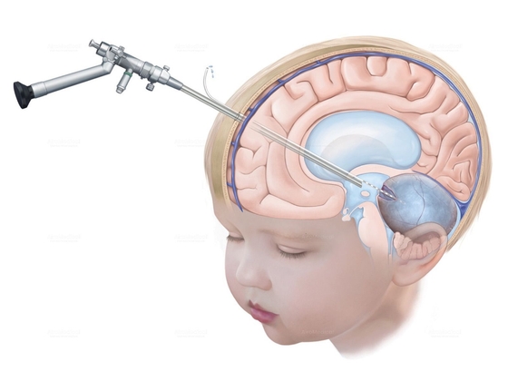 Brain cyst treatment with endoscopic cyst drainage surgery