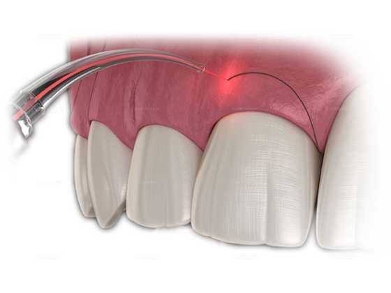 Gum tissue removal (gingivectomy)