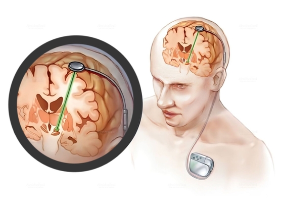 Parkinson's disease treatment with deep brain stimulation (DBS)