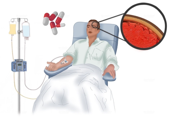 Meningitis treatment with conservative medications