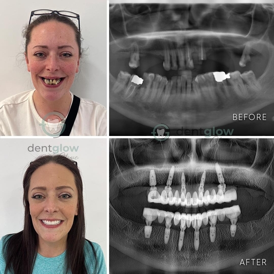 All on-6 Full Mouth Implantation: Teeth Extractions + Bone Graft 2cc ...