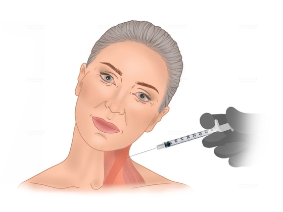 Dystonia treatment with Botox injections