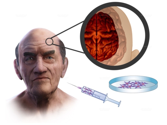 Brain atrophy treatment with stem cell therapy