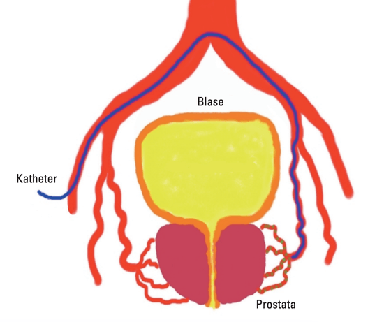 Prostate Embolization for Benign Prostatic Hyperplasia (BPH ...